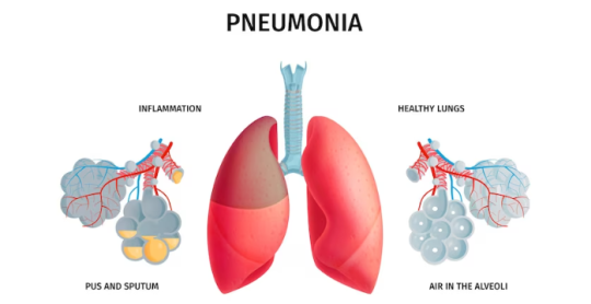 Hypersensitivity Pneumonitis: Causes, Symptoms and Treatment